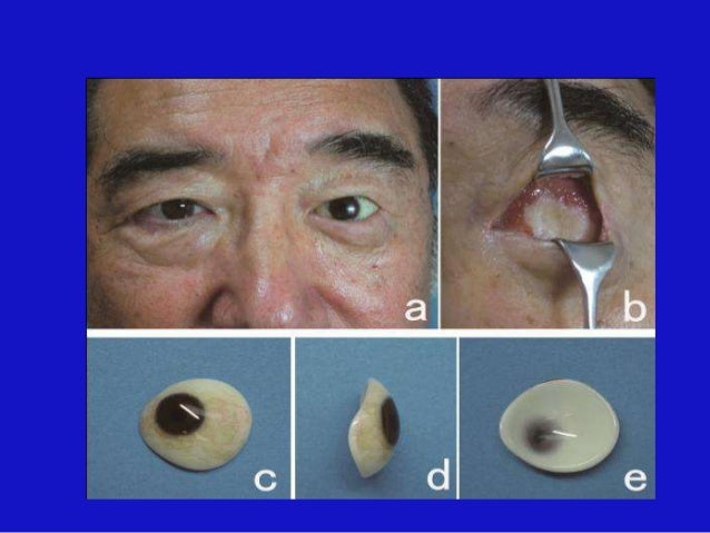 Contracted eye socket reconstruction