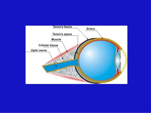 Contracted eye socket reconstruction