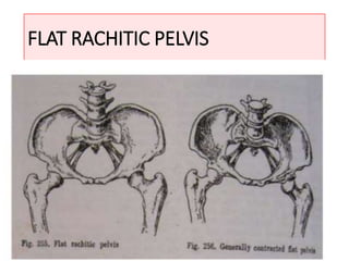 Rachitic Pelvis