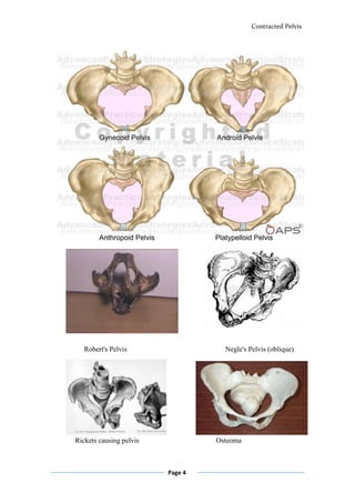 Contracted pelvis (diagnosis and treatment) | DOCX
