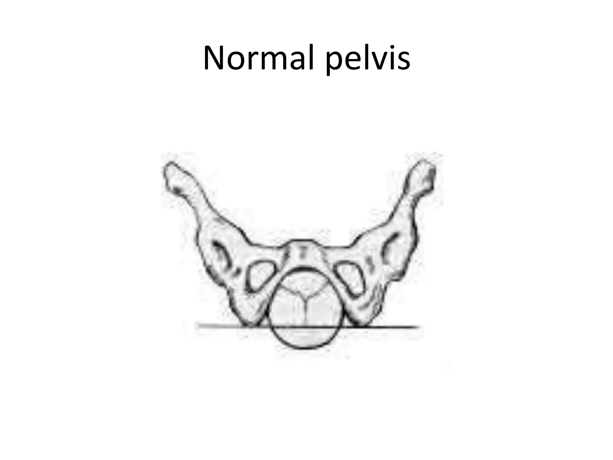 Contracted pelvis | PPTX | Pregnancy | Reproductive Health