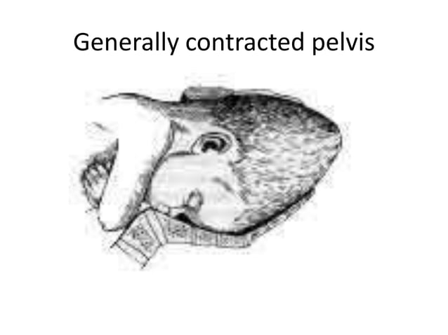 Contracted pelvis | PPTX | Pregnancy | Reproductive Health