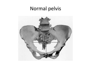 Contracted pelvis | PPTX | Pregnancy | Reproductive Health