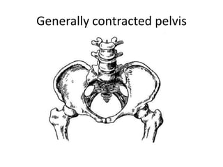 Contracted pelvis | PPTX | Pregnancy | Reproductive Health