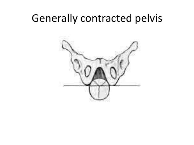 Contracted pelvis