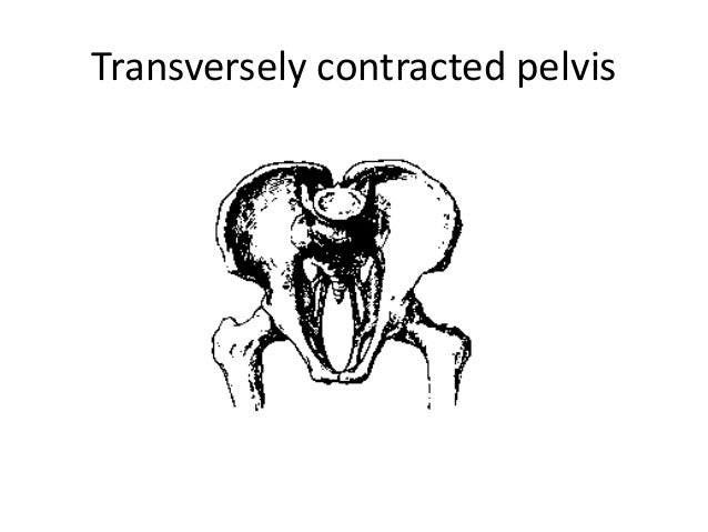 Contracted pelvis