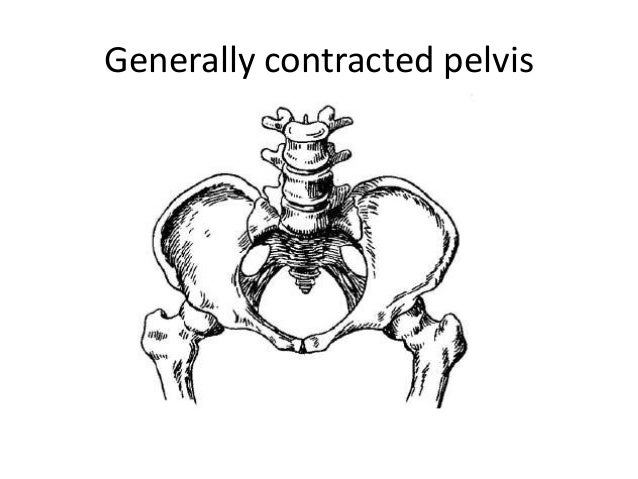 Contracted pelvis