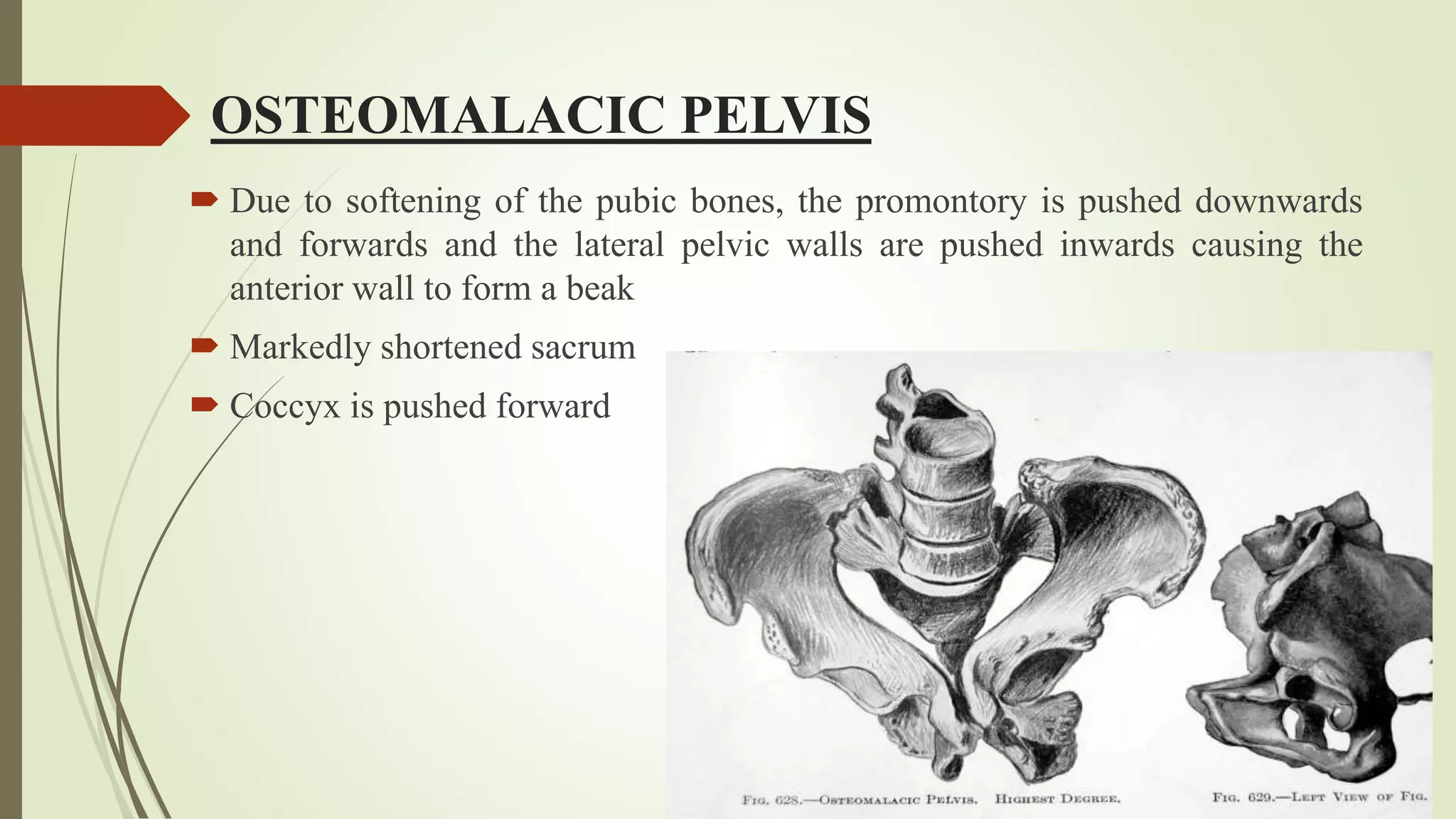 Contracted pelvis | PPTX
