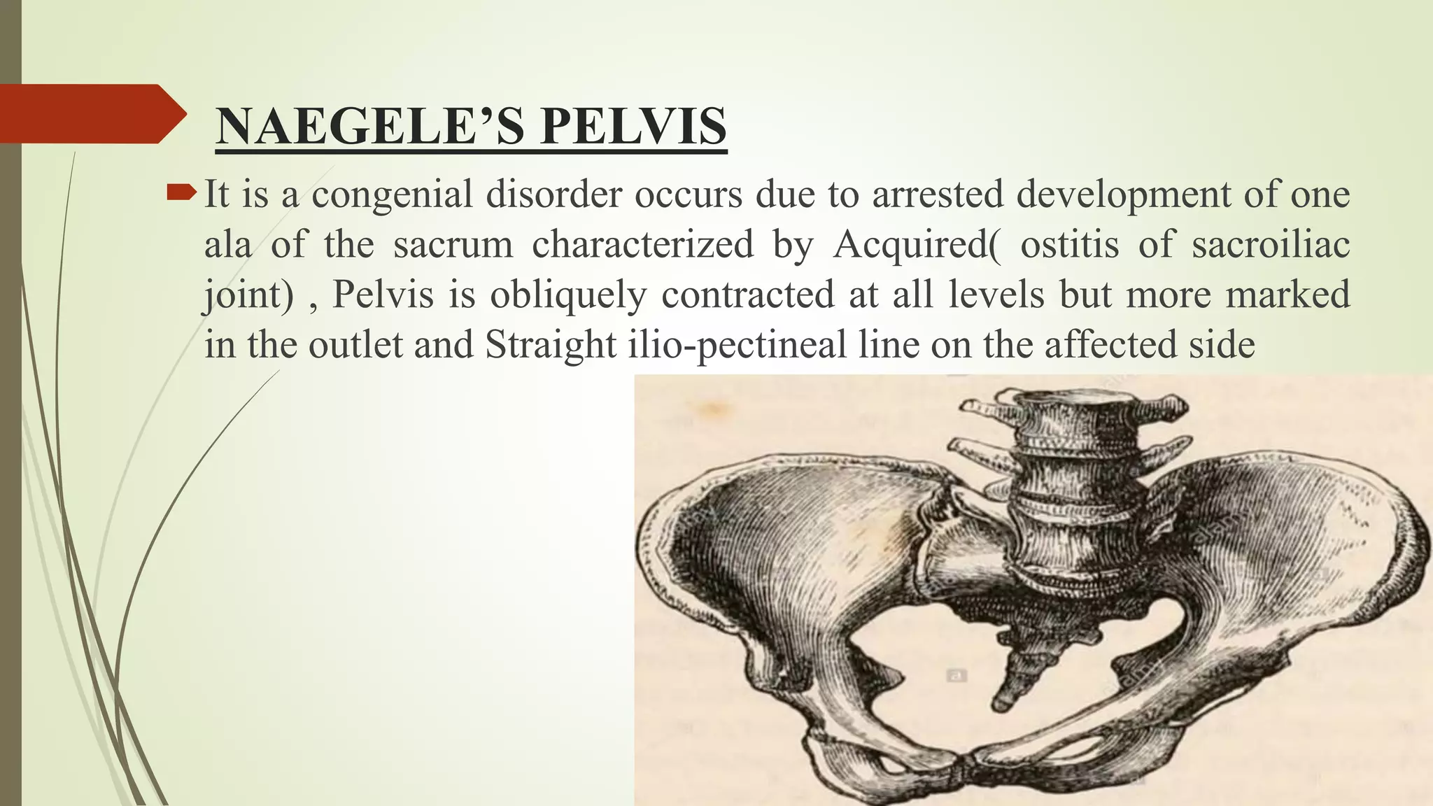 Contracted pelvis | PPTX