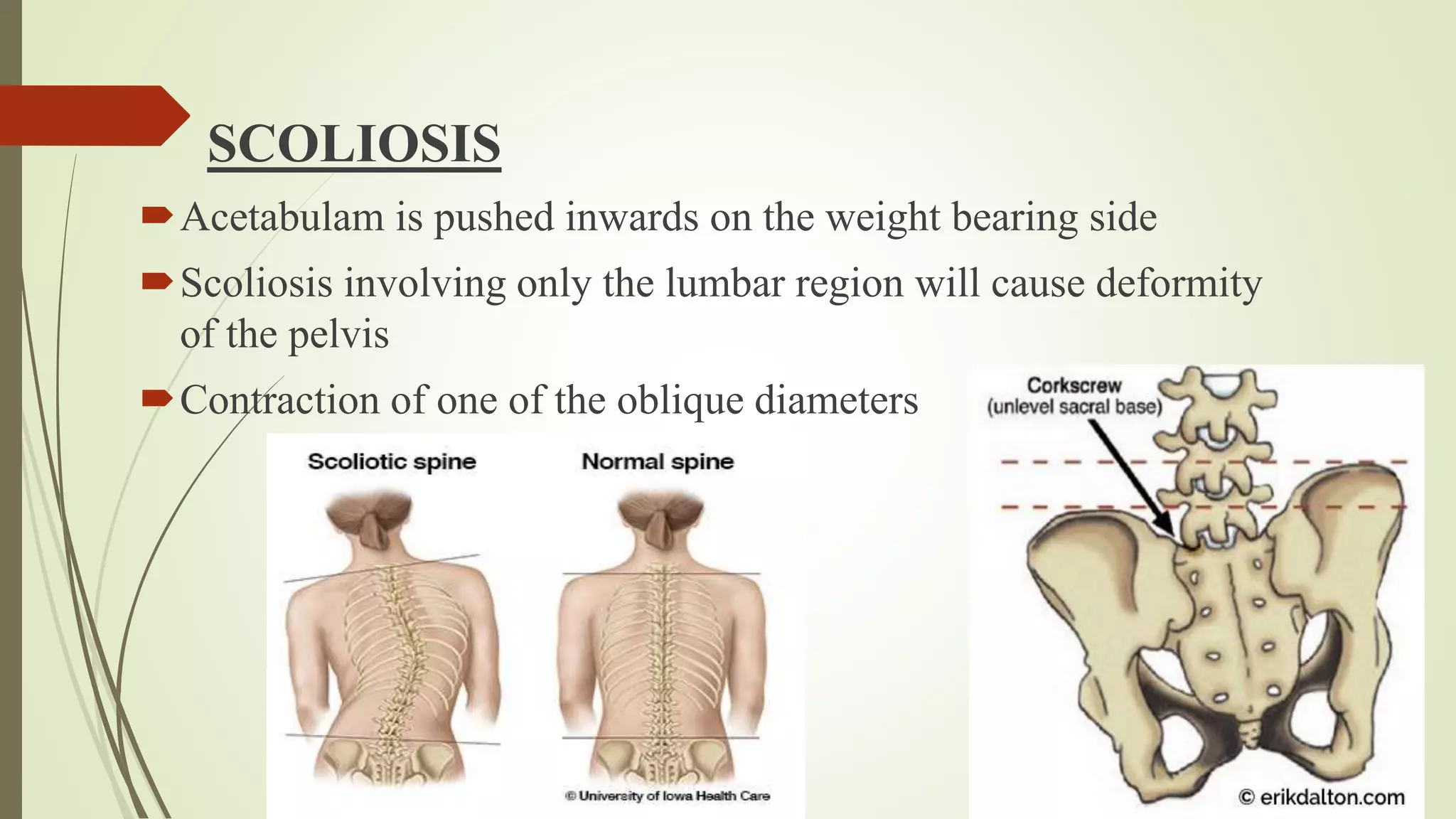 Contracted pelvis | PPTX