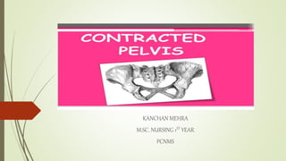 Contracted pelvis | PPTX