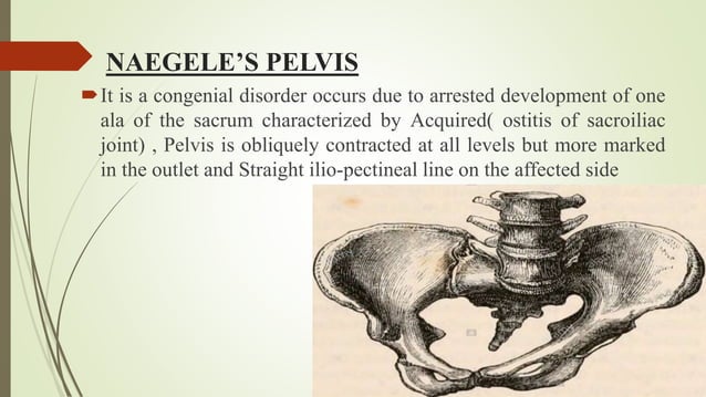 Contracted pelvis | PPTX