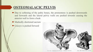 Rachitic Pelvis