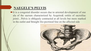 Naegeles Pelvis