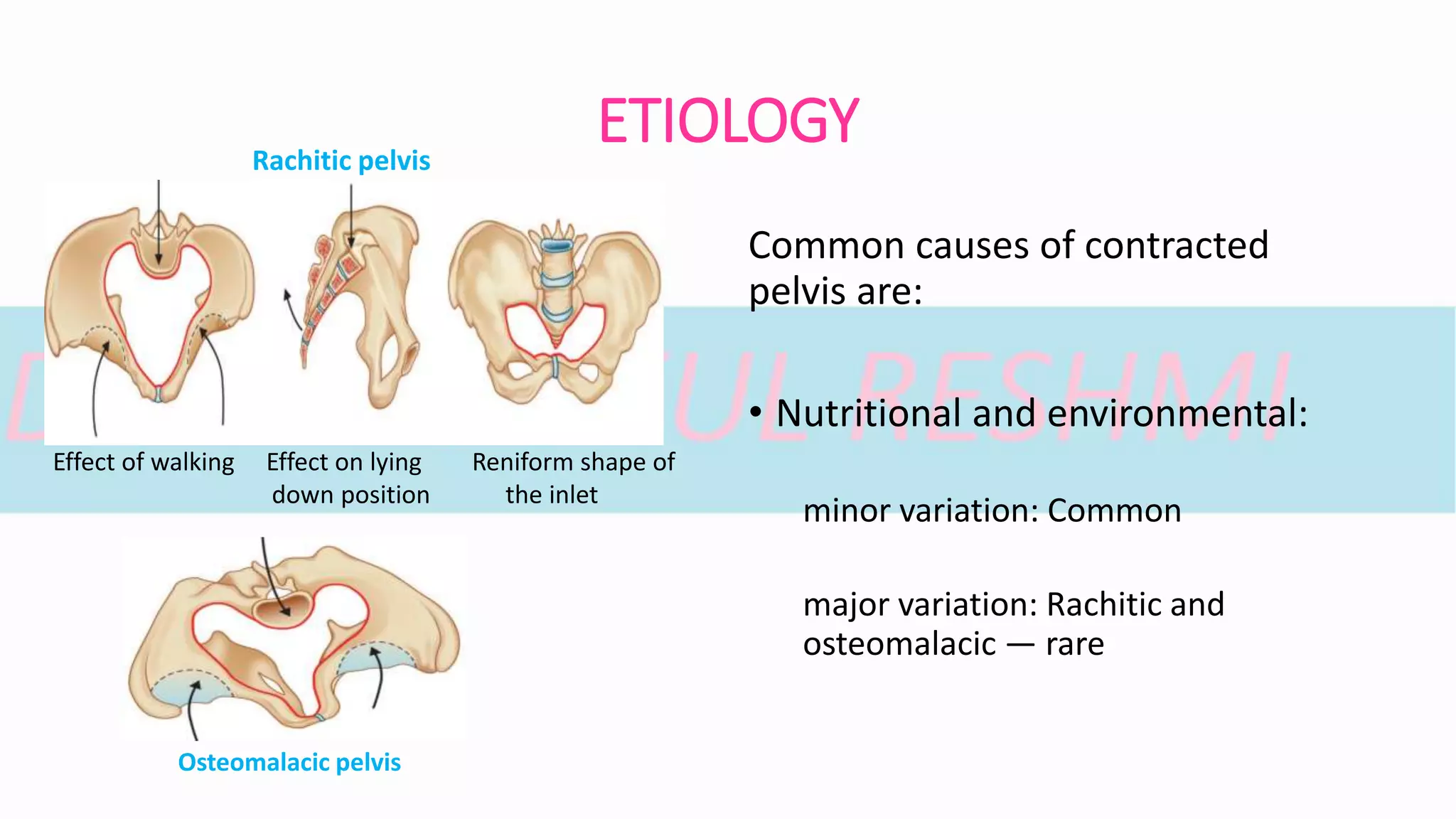 Contracted pelvis - CEPHALOPELVIC DISPROPORTION | PPTX