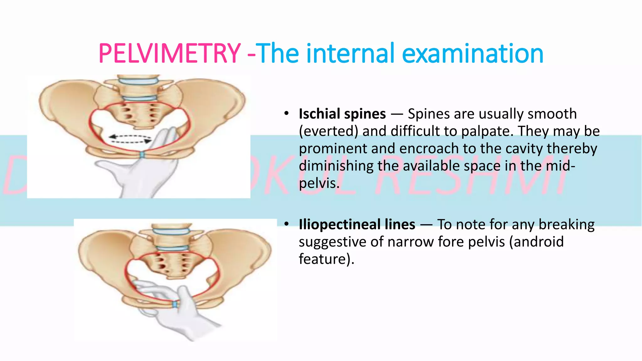 Contracted pelvis - CEPHALOPELVIC DISPROPORTION | PPTX