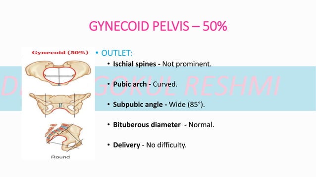 Contracted pelvis - CEPHALOPELVIC DISPROPORTION | PPTX
