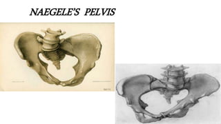 Naegeles Pelvis