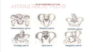 Osteomalacic Pelvis