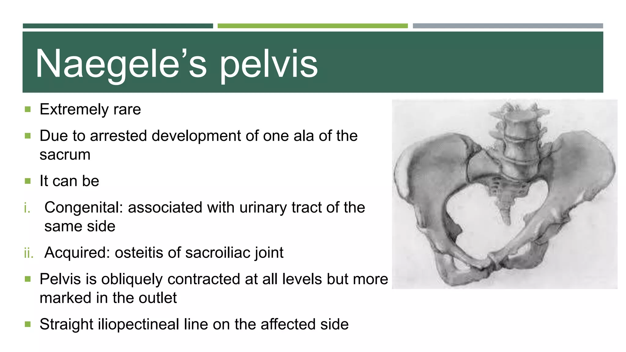 Contracted pelvis | PPTX