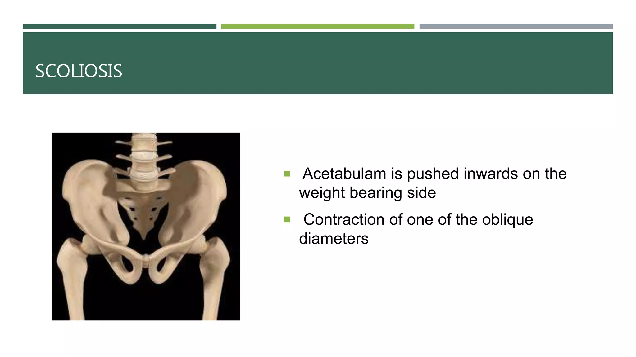Contracted pelvis | PPTX