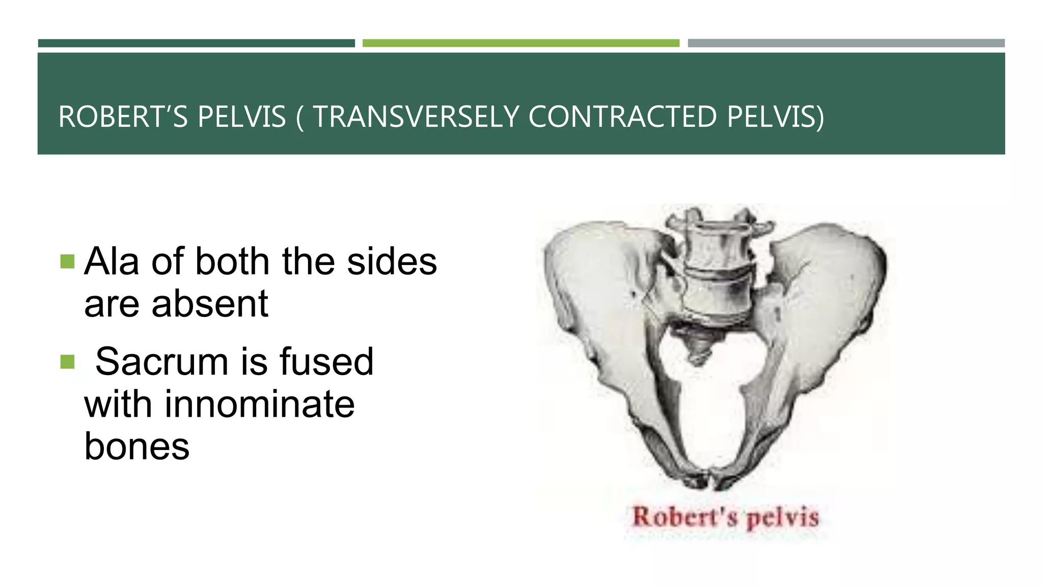 Contracted pelvis | PPTX