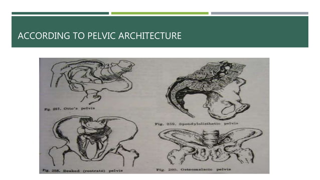 Contracted pelvis | PPTX | Pregnancy | Reproductive Health