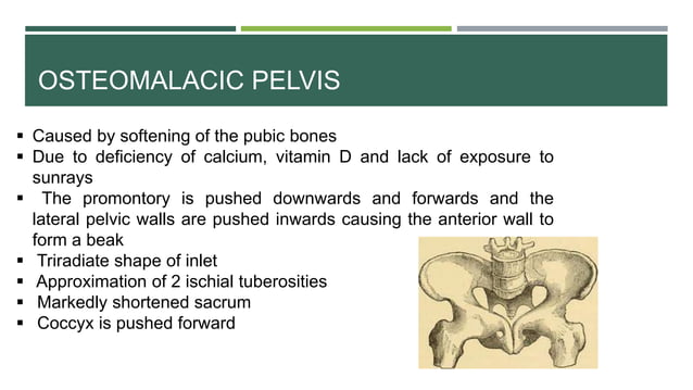 Contracted pelvis | PPTX | Pregnancy | Reproductive Health