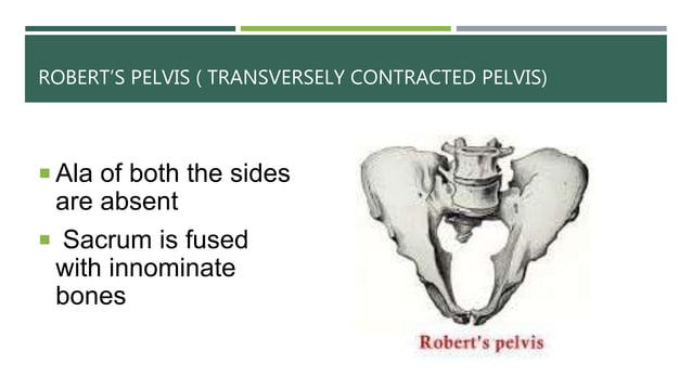 Contracted pelvis | PPTX | Pregnancy | Reproductive Health