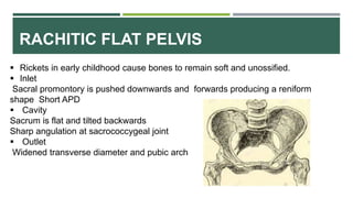 Rachitic Pelvis