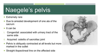 Naegeles Pelvis
