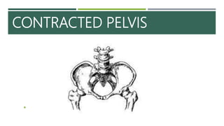 Rachitic Pelvis
