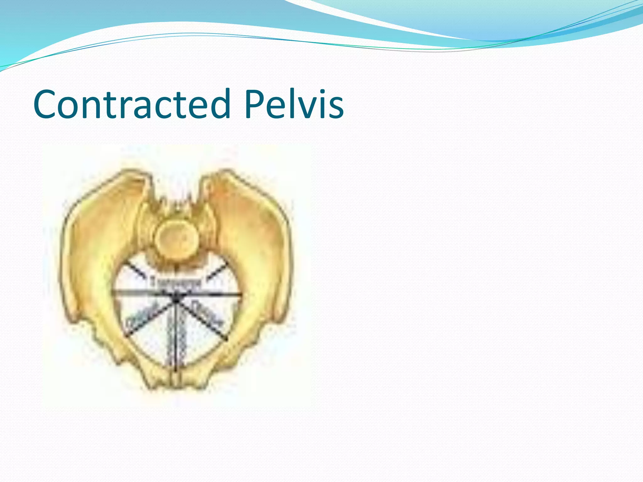 Contracted pelvis.PPT