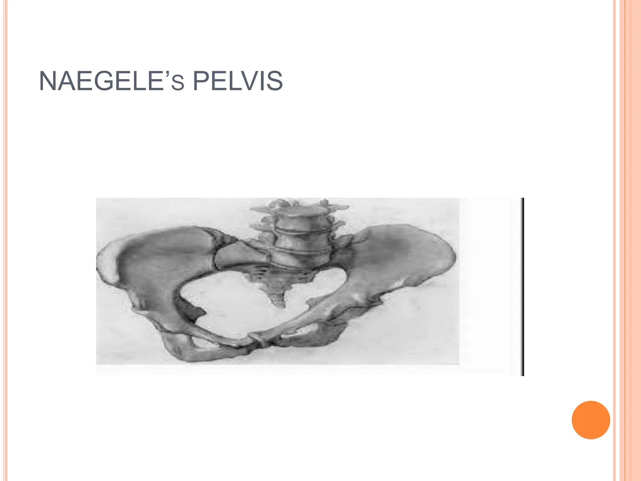Obg contracted pelvis and other pelvic deformations | PPTX