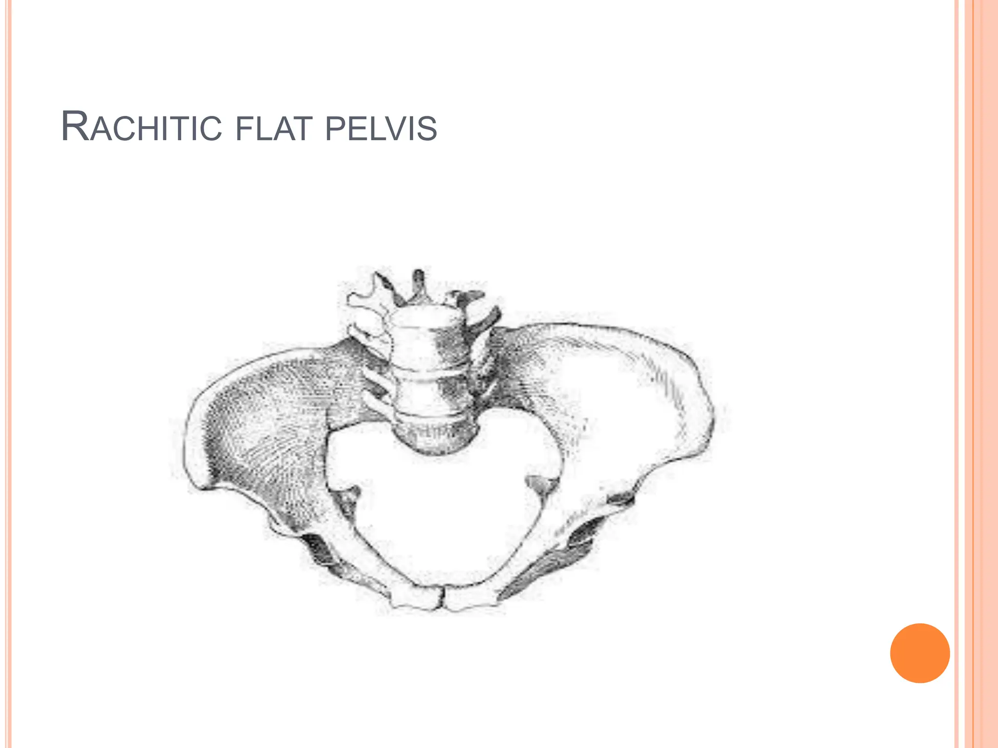 Obg contracted pelvis and other pelvic deformations | PPTX