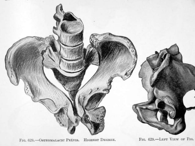 Obg contracted pelvis and other pelvic deformations | PPT
