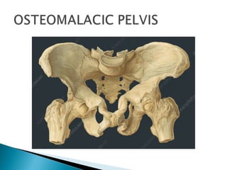 Types of pelvis and contracted pelvis ppt | PPT