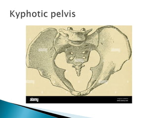 Types of pelvis and contracted pelvis ppt | PPT