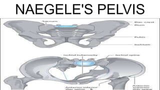 Naegeles Pelvis