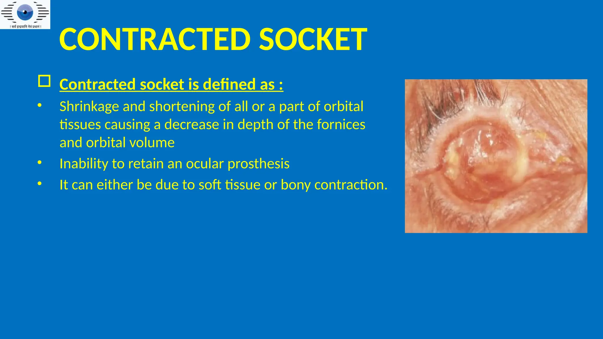 CONTRACTED SOCKET , CLINICAL PRESENTATION , FEATURES , MANAGEMENT | PPTX