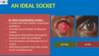 CONTRACTED SOCKET , CLINICAL PRESENTATION , FEATURES , MANAGEMENT | PPTX