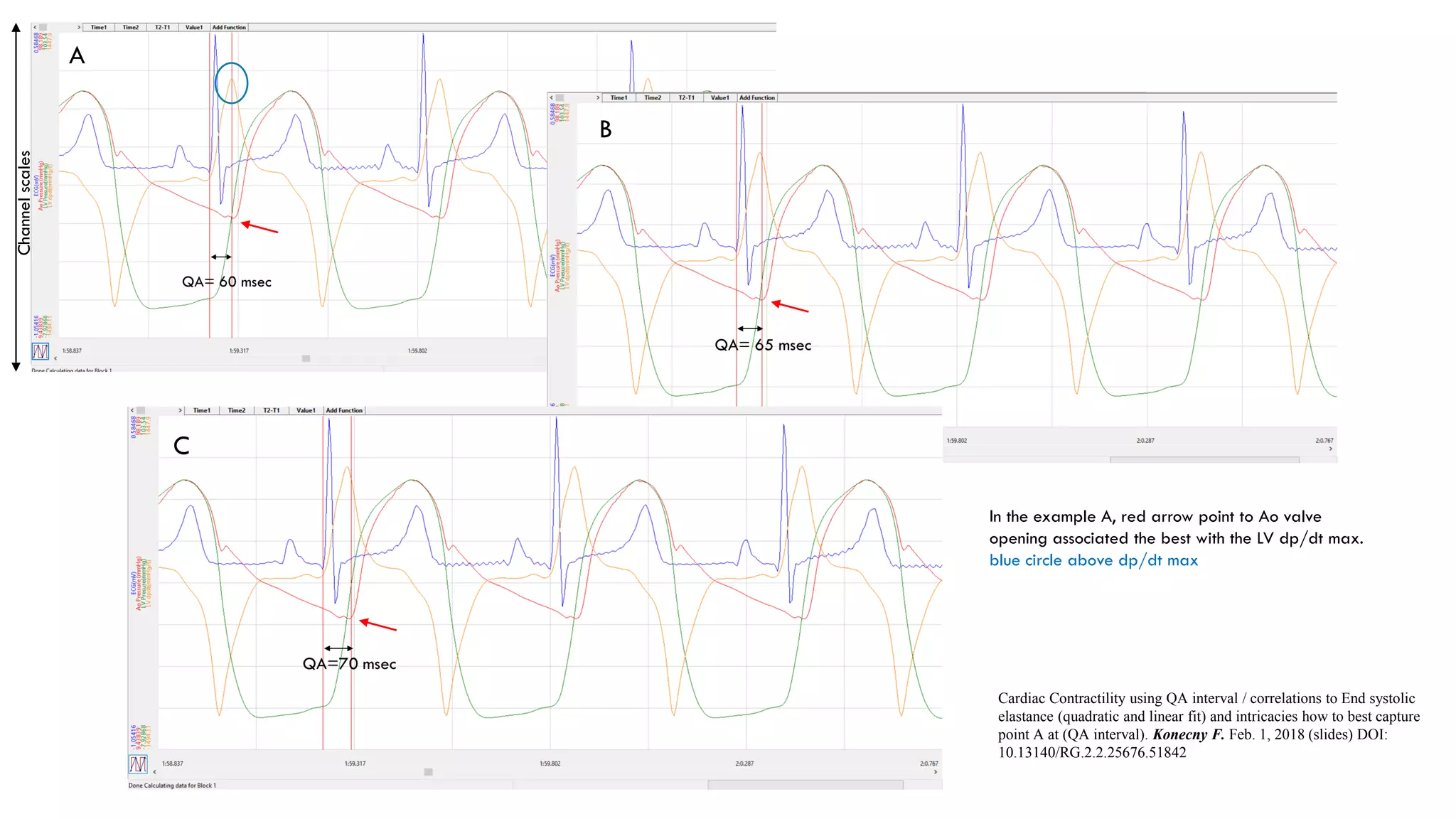 Cardiac Contractility using QA interval | PPT