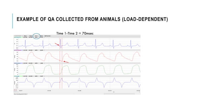Cardiac Contractility Using Qa Interval Ppt