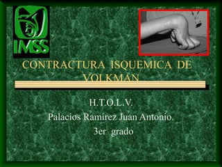 Contractura isquemica de volkman | PPT