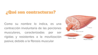 Contracturas.pptx