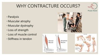 Contracture | PPTX