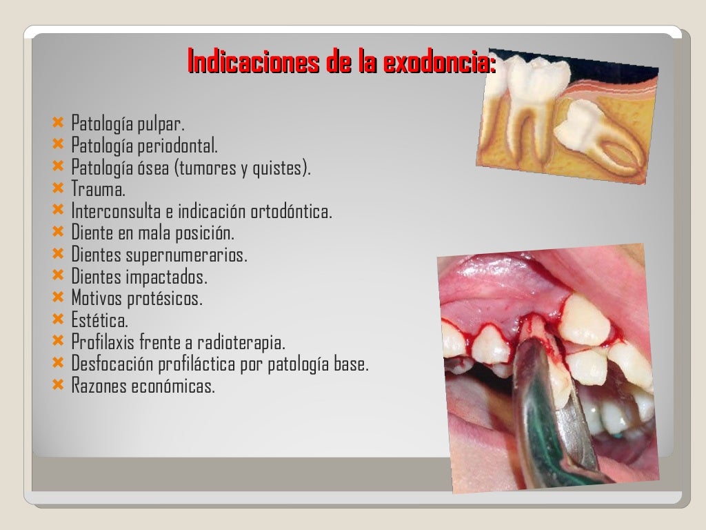 Contraindicaciones de la exodoncia e indicaciones postoperatorias