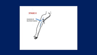 Contralateral c7 CC7 transfer | PPTX