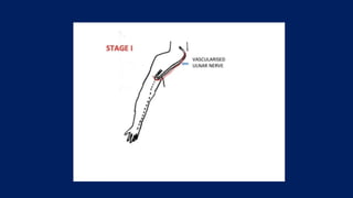 Contralateral c7 CC7 transfer | PPTX