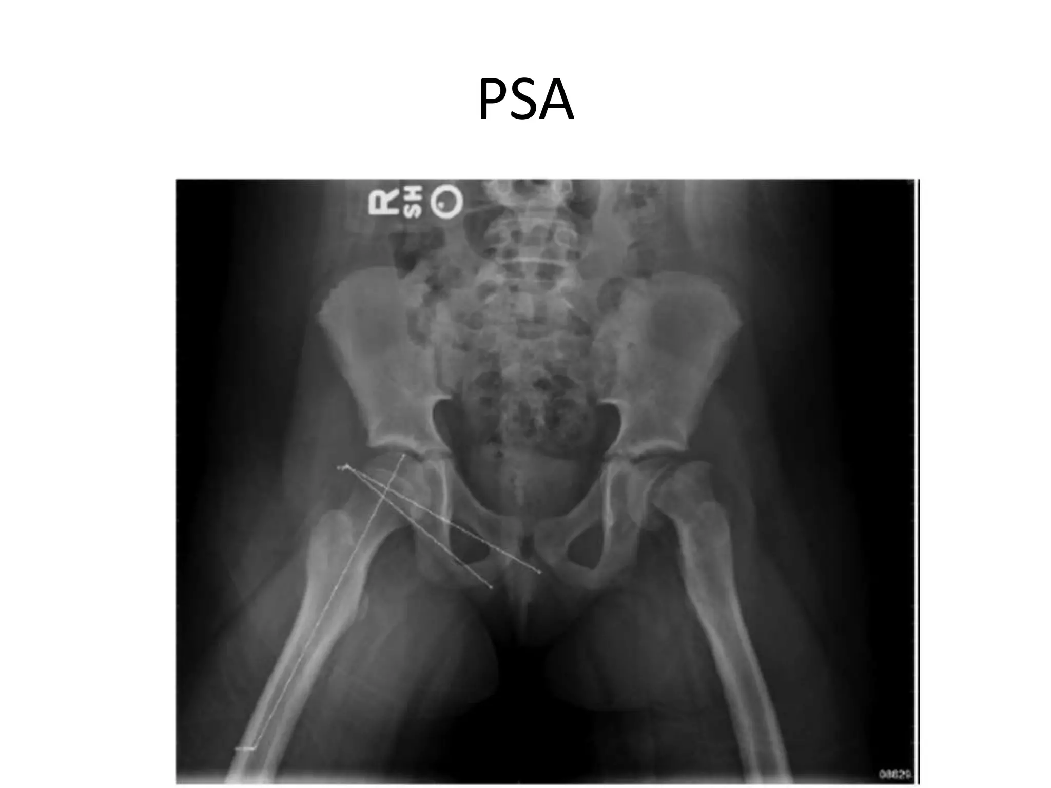 Contralateral fixation of scfe | PPT